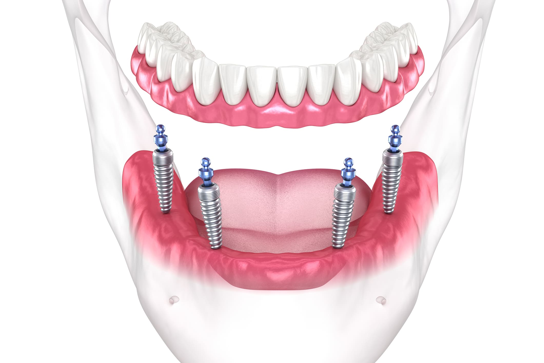All On Four Dental Implants Wilmington, DE